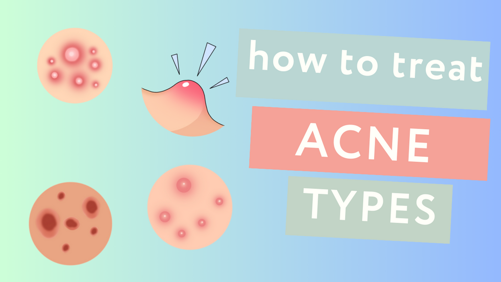 Exploring the Different Types of Acne Lesions and How to Treat Them ...